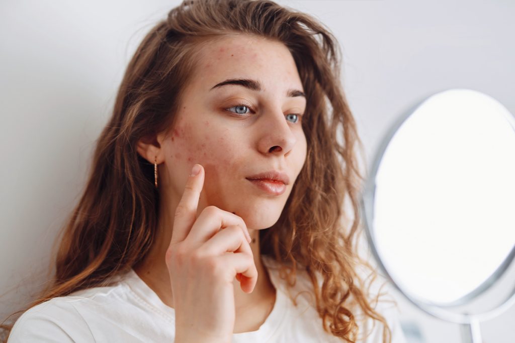 As 14 Melhores Cremes para Eliminar Borbulhas e Acne