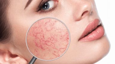 Cuperosis: qué es, por qué sale y cómo curarla