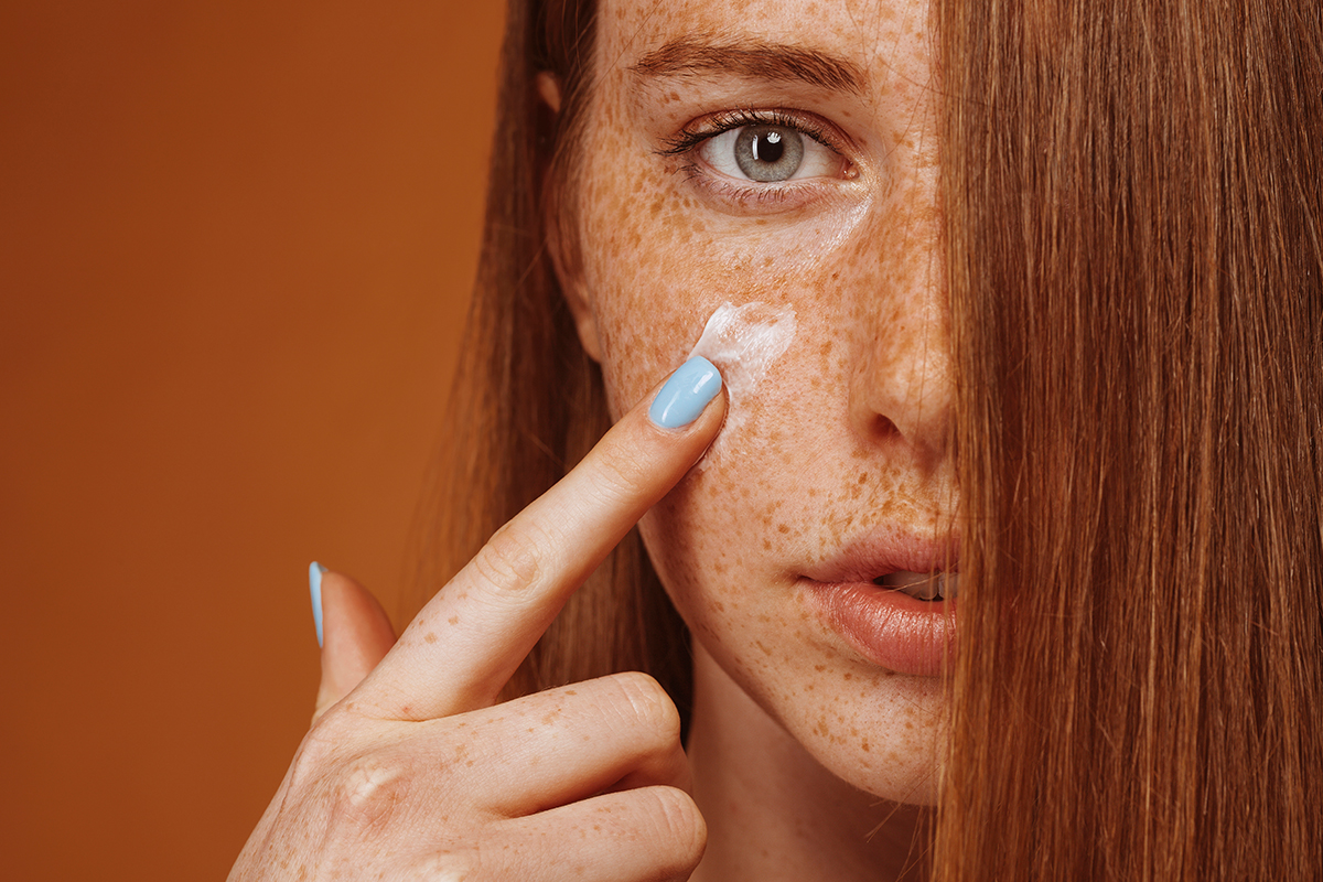 Melasma: qué es y cuáles son las mejores cremas para eliminarlo