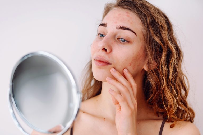 Si tienes psoriasis en la cara, así es cómo debes tratarla