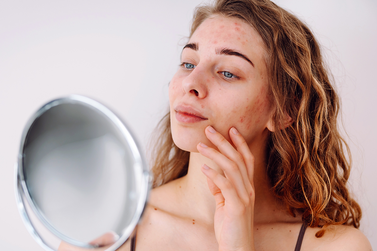 Si tienes psoriasis en la cara, así es cómo debes tratarla