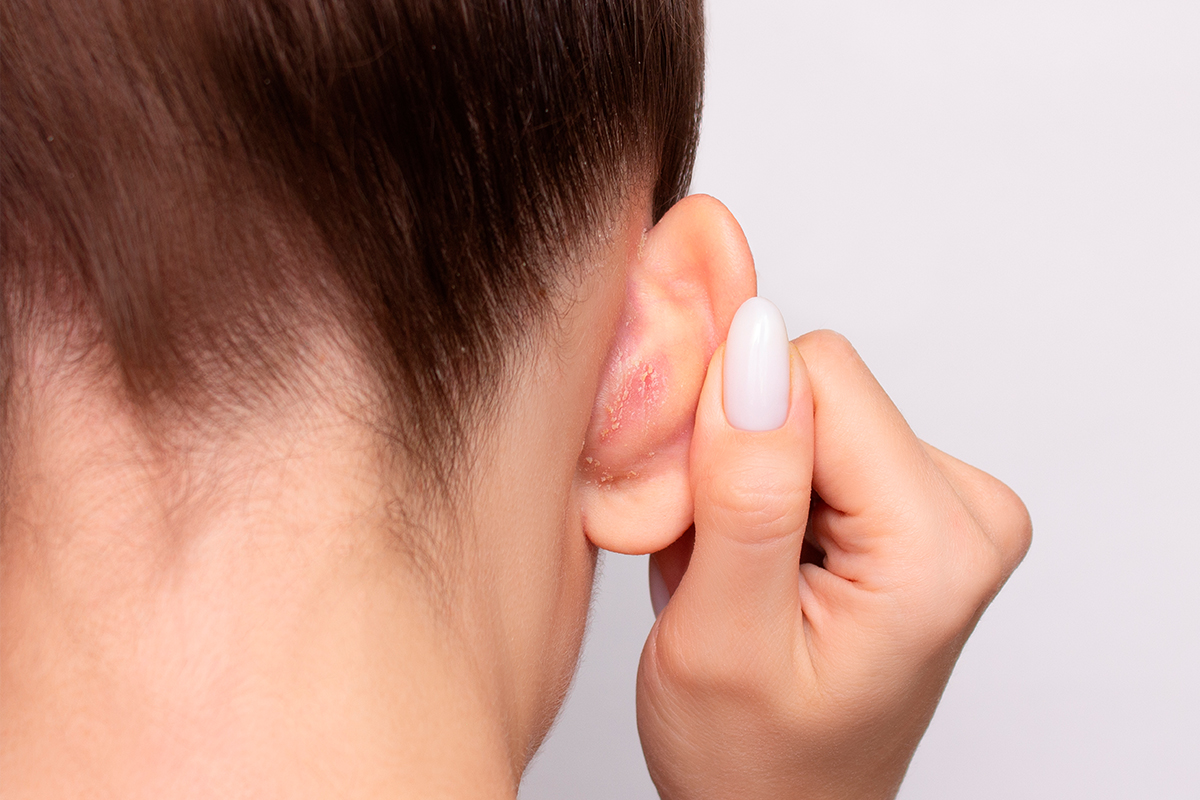 Cómo tratar la dermatitis seborreica en las orejas