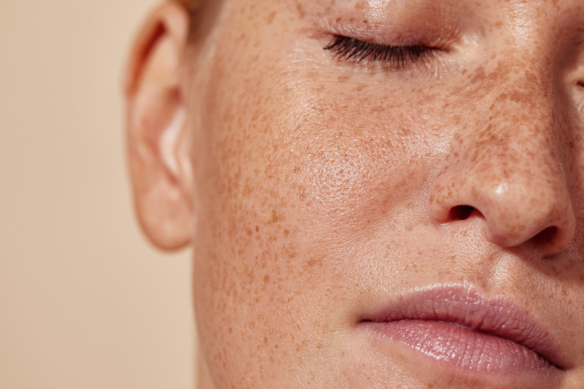 Qué son las pecas y cómo proteger la piel