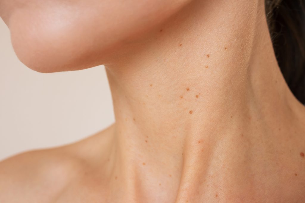 Los diferentes tipos de verrugas y cómo tratar cada una de ellas