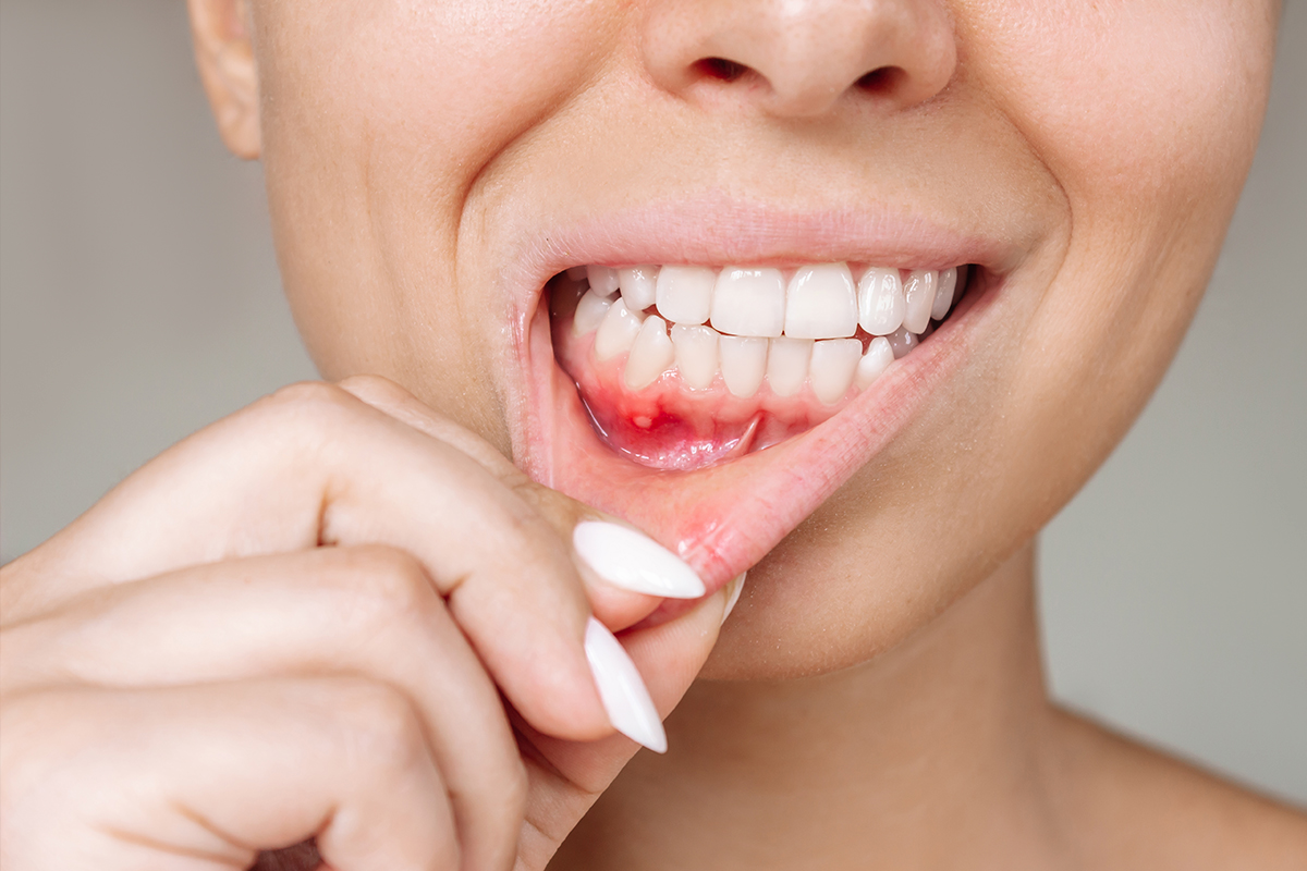 Motivos y causas por las que pueden salirte úlceras