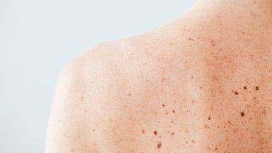 Qué es el melasma corporal