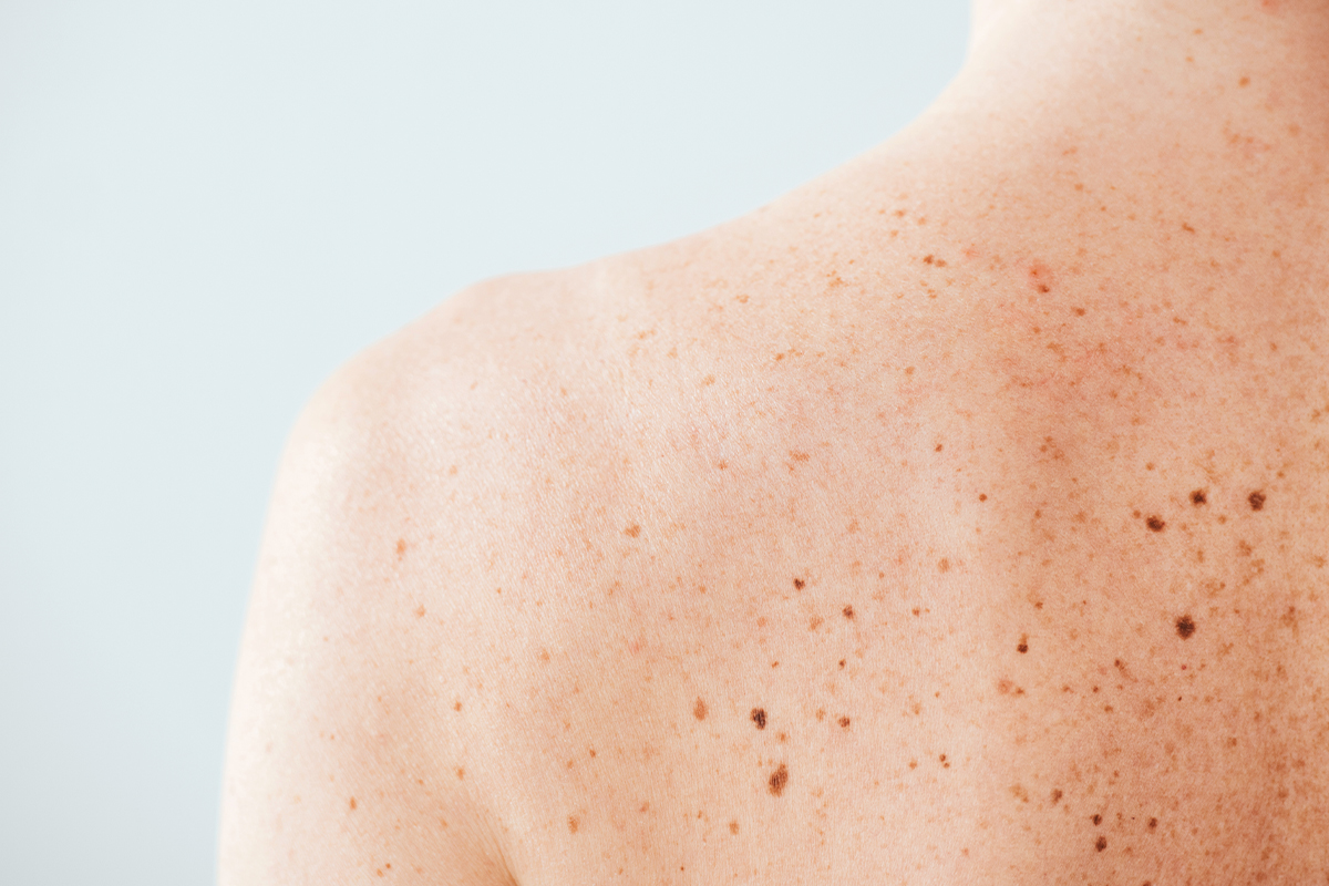 Qué es el melasma corporal