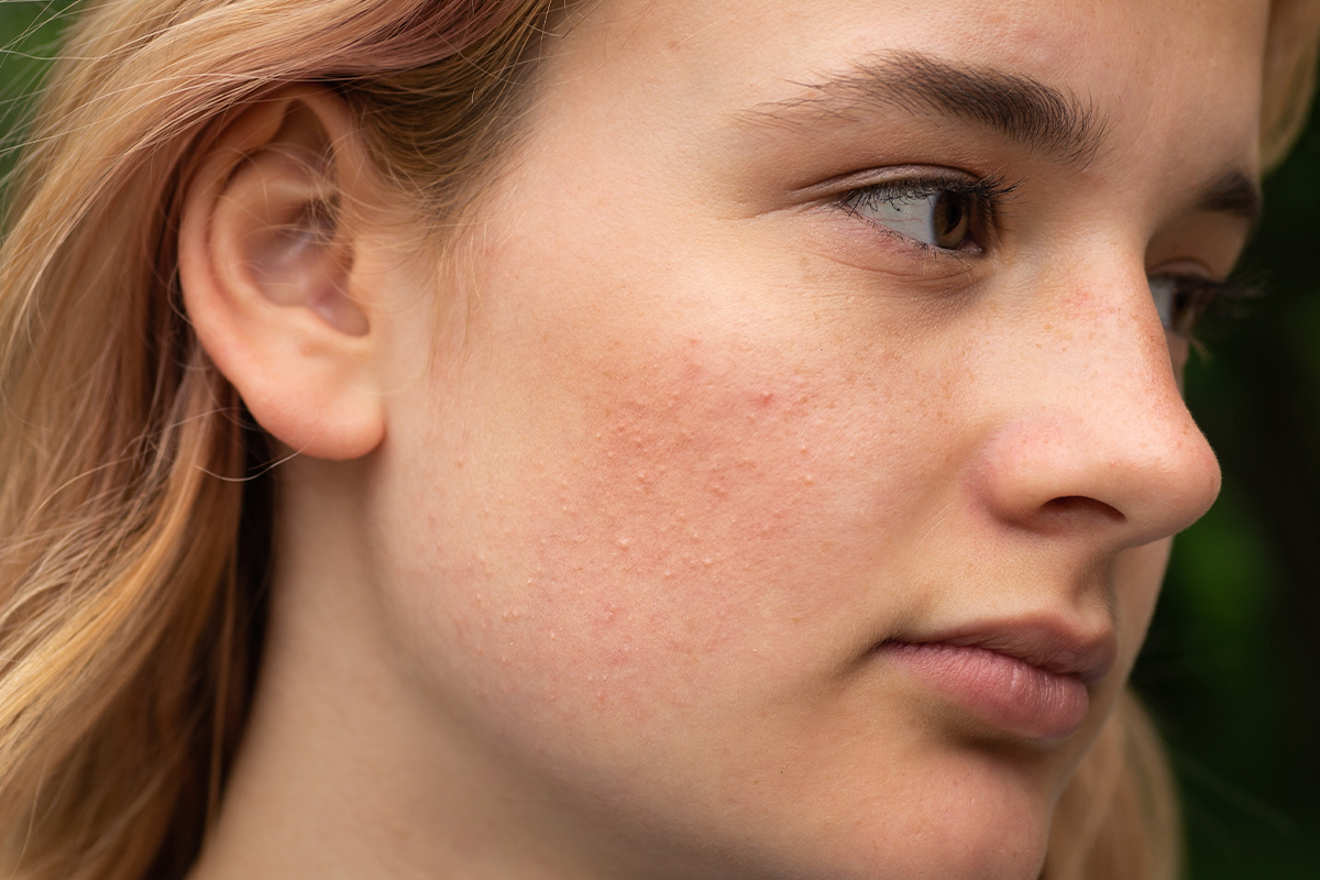 ¿Qué son las pústulas?